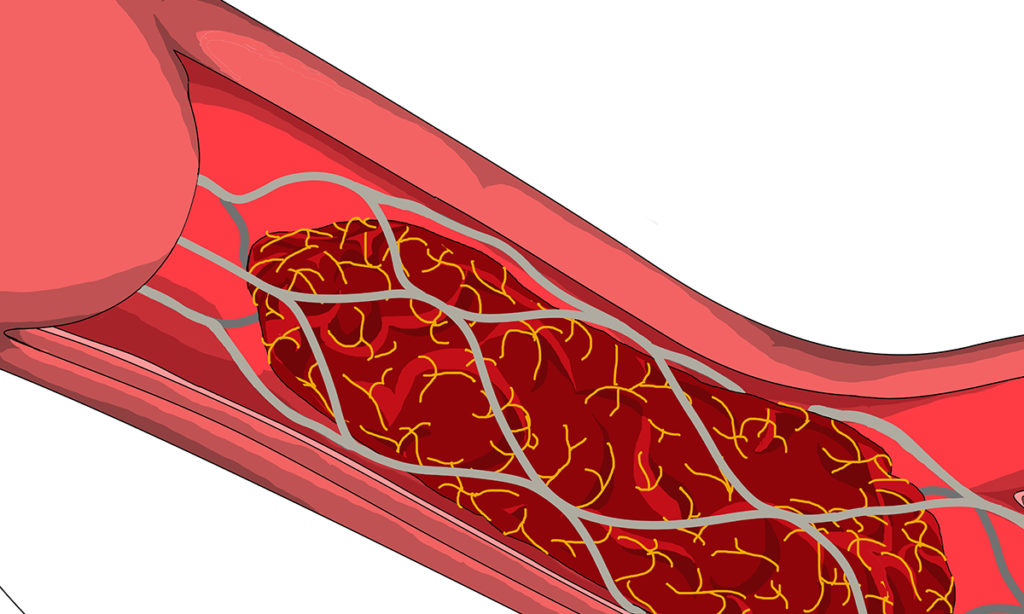 Stroke care: “tissue clock” may replace “time clock” | InSight+