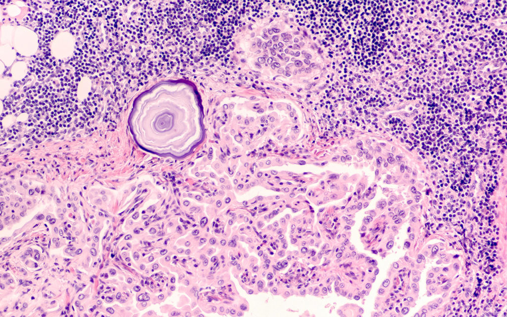 Risk of second primary cancers in survivors of childhood cancer | InSight+