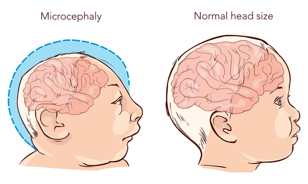 Zika prep confirms microcephaly and FASD link | InSight+